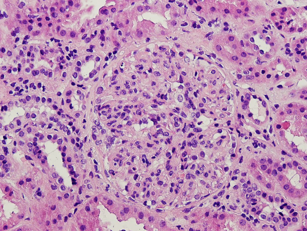 AJKD Blog – Official Blog of the American Journal of Kidney Diseases