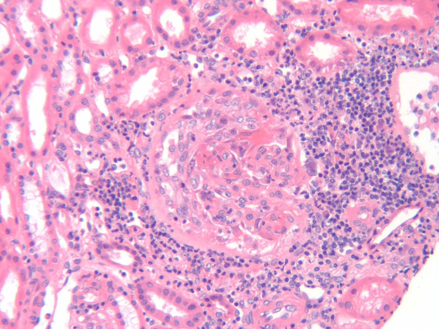 glomerular diseases – AJKD Blog