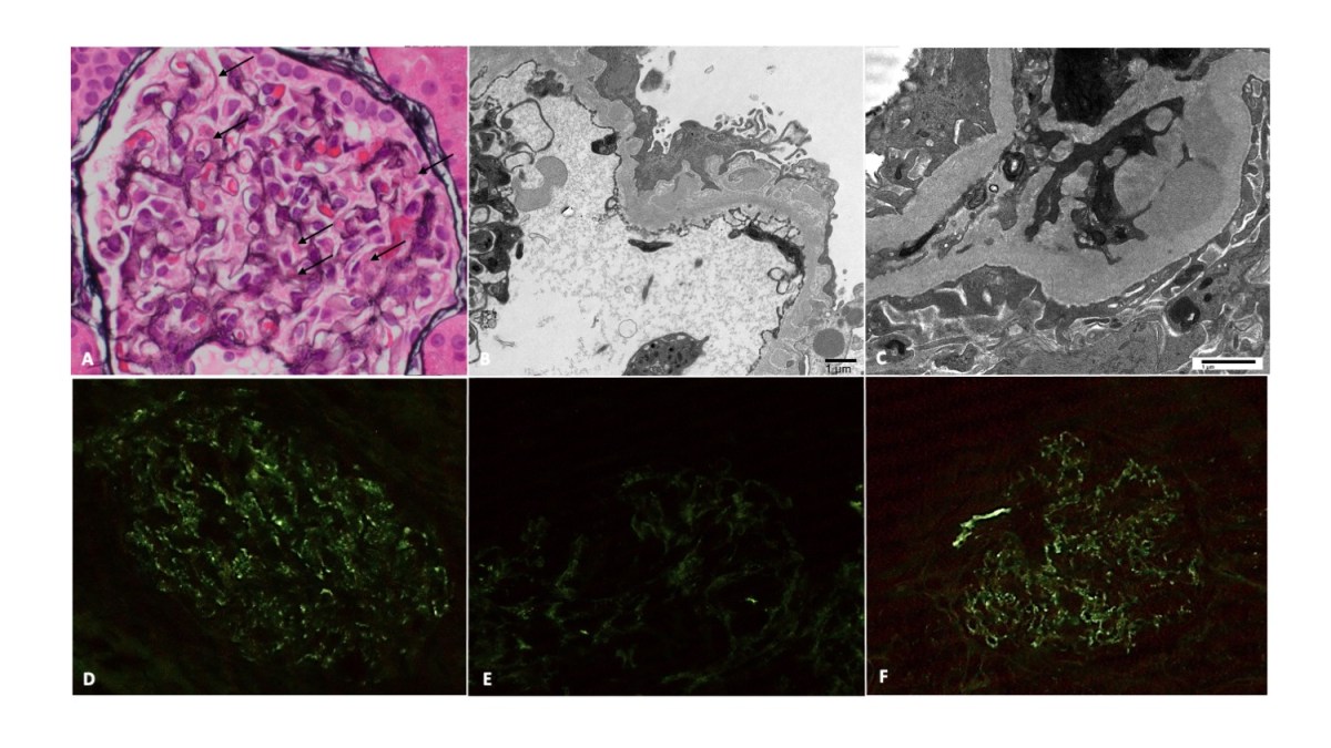 #PathPointer: Membranous-Like Glomerulopathy With Masked IgG Kappa ...
