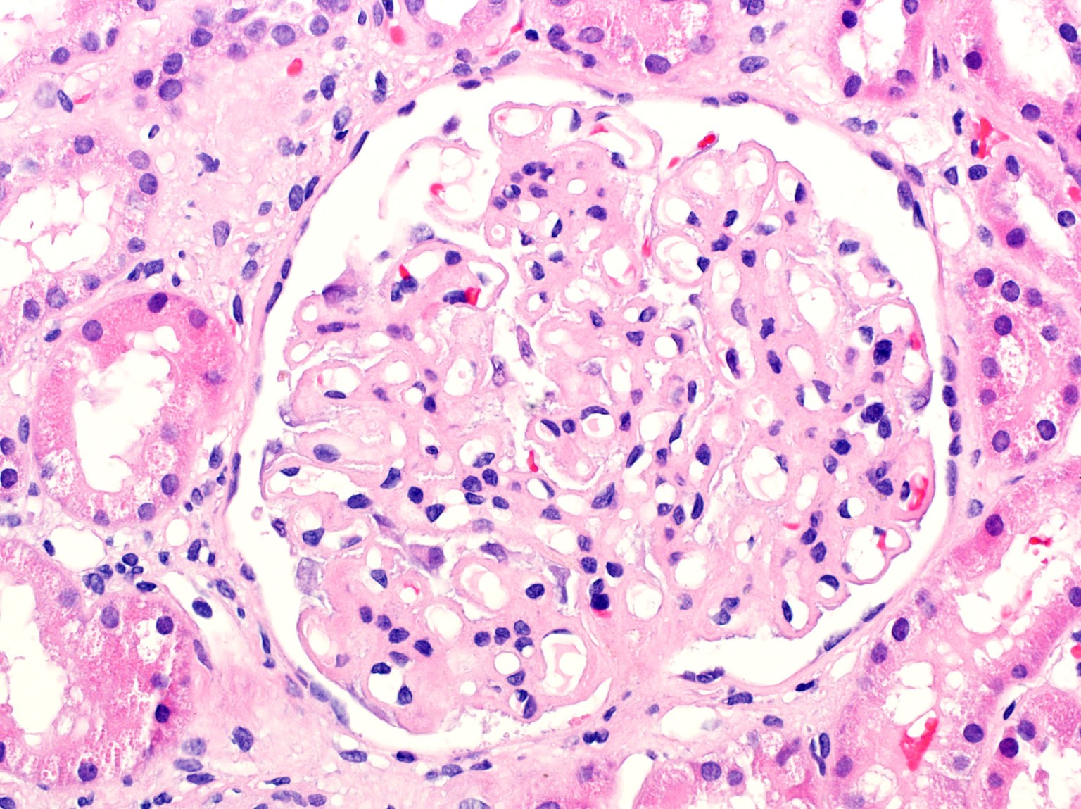 #NephMadness 2022: Nephropath Region – AJKD Blog