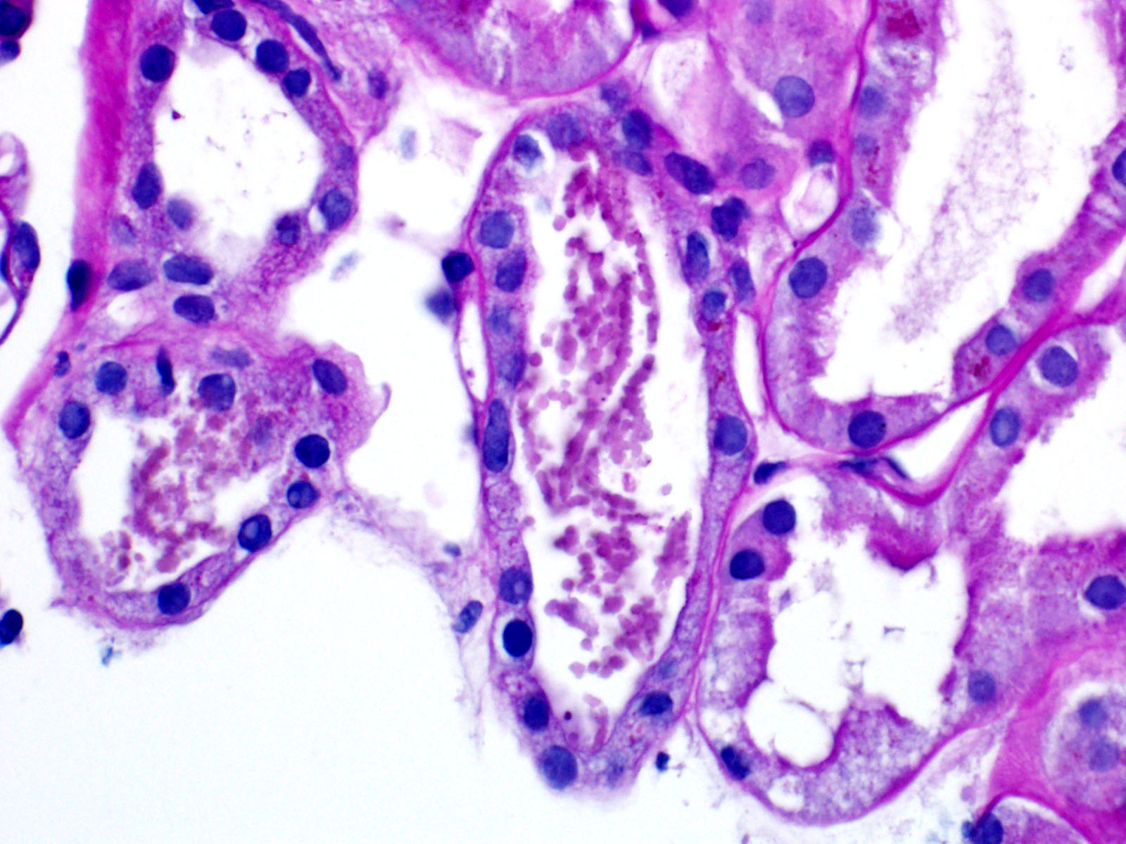 #PathPointer: Casts Give Us Clues – Pigmented Granular Casts on Kidney ...
