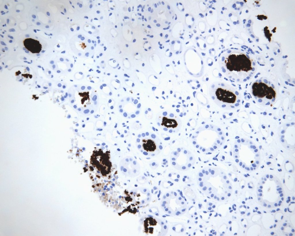 #PathPointer: Casts Give Us Clues – Pigmented Granular Casts on Kidney ...