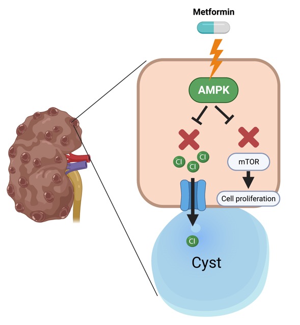 Is Metformin Now in Our Armamentarium for Autosomal Dominant Polycystic ...