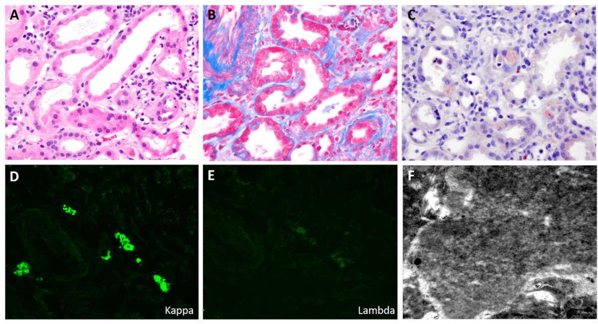 #PathPointer: An Atypical Location for Amyloid – Intratubular ...