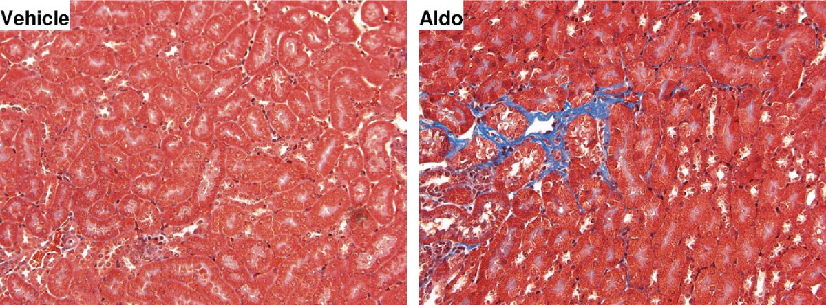 #NephMadness 2023: Mineralocorticoid Receptor Antagonists Region – AJKD ...