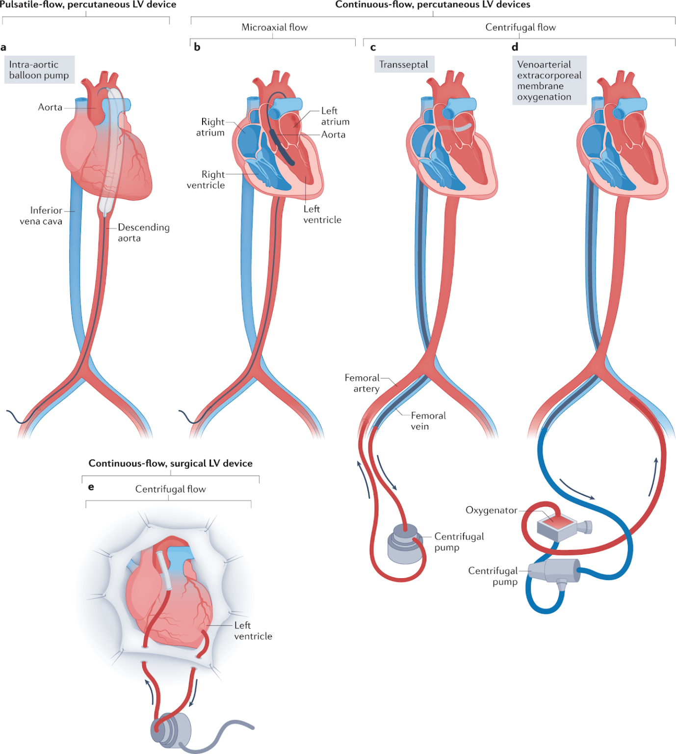 #NephMadness 2023: Heart Failure Devices Region – AJKD Blog