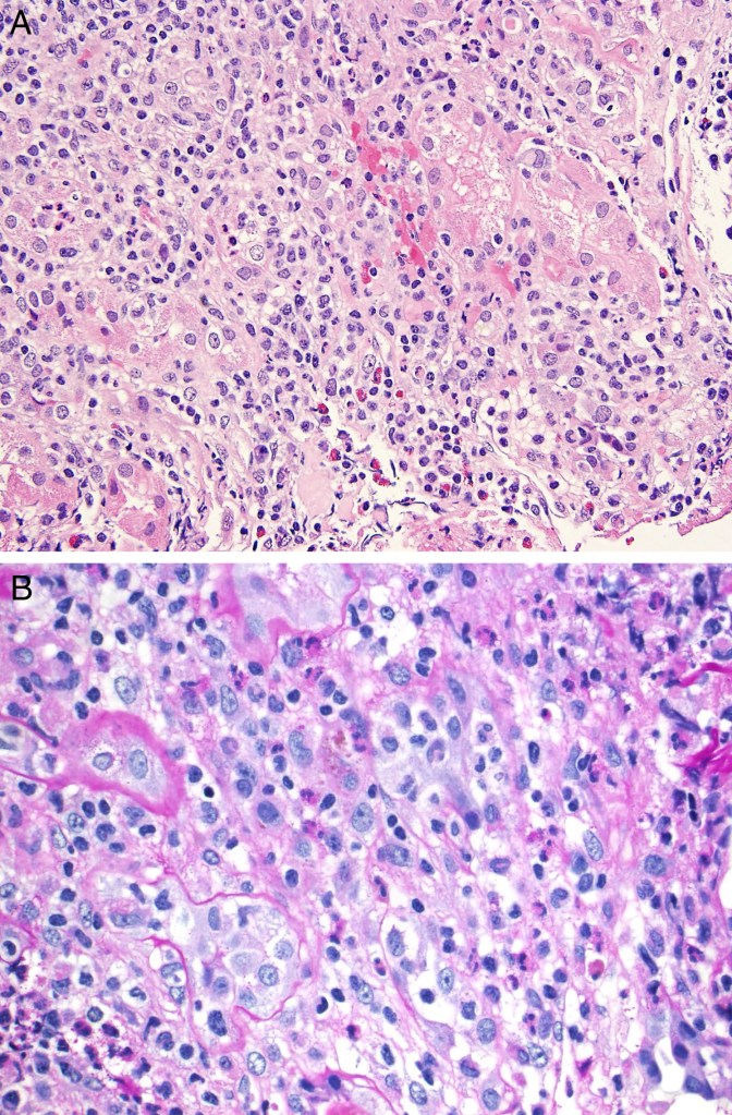 #NephMadness 2023: Onconephrology Region – AJKD Blog