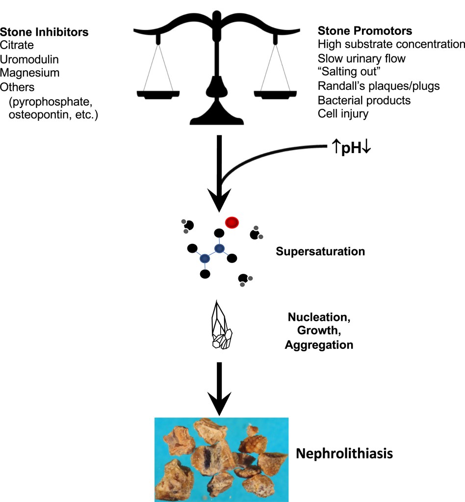 Nephrolithiasis: An Interview – AJKD Blog
