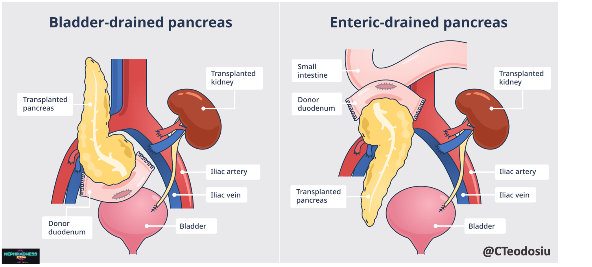 #NephMadness 2024: Dual-Organ Transplant Region – AJKD Blog